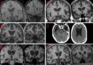 Brain Scans of Dementia Patients with Coprophagia Showed ...