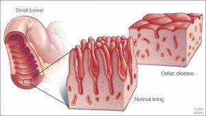 Mayo Clinic Q and A: Following Gluten-Free Diet for Celiac Disease ...