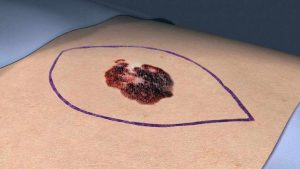Removing skin cancer with Mohs surgery - Mayo Clinic News Network