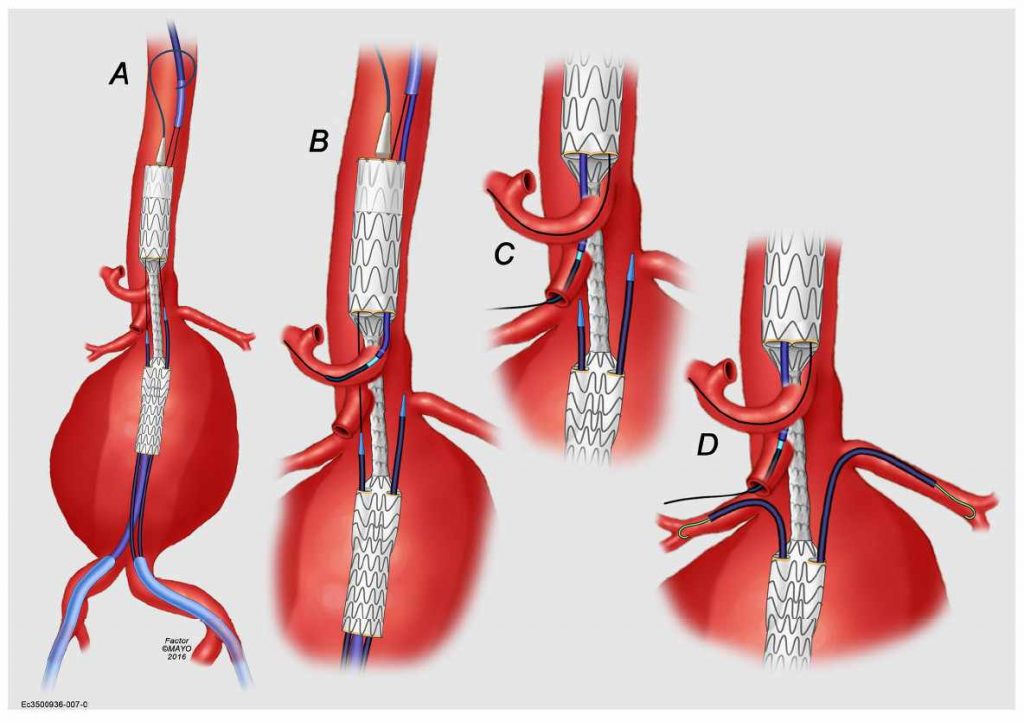 Aortic Aneurysm Muhc Aortic Clinic Mcgill University