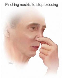 Mayo Clinic Q and A: Nosebleeds Usually Nothing to Worry About - Mayo ...