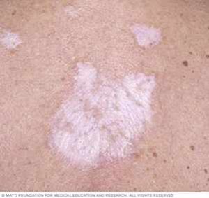 Mayo Clinic Q and A: Lichen Sclerosus Needs Ongoing Care - Mayo Clinic ...