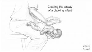 Saving lives with the Heimlich Maneuver - Mayo Clinic News Network