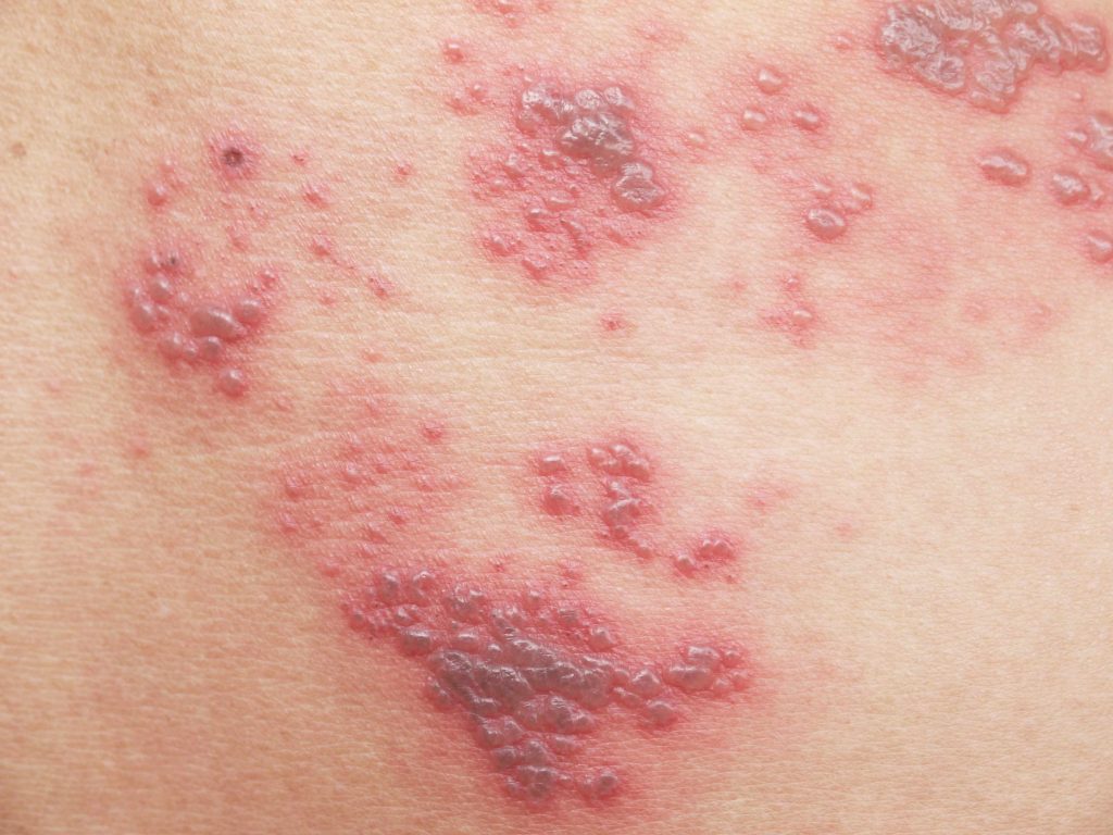 Mayo Clinic Q and A: Vaccine recommended for older adults even if they ...