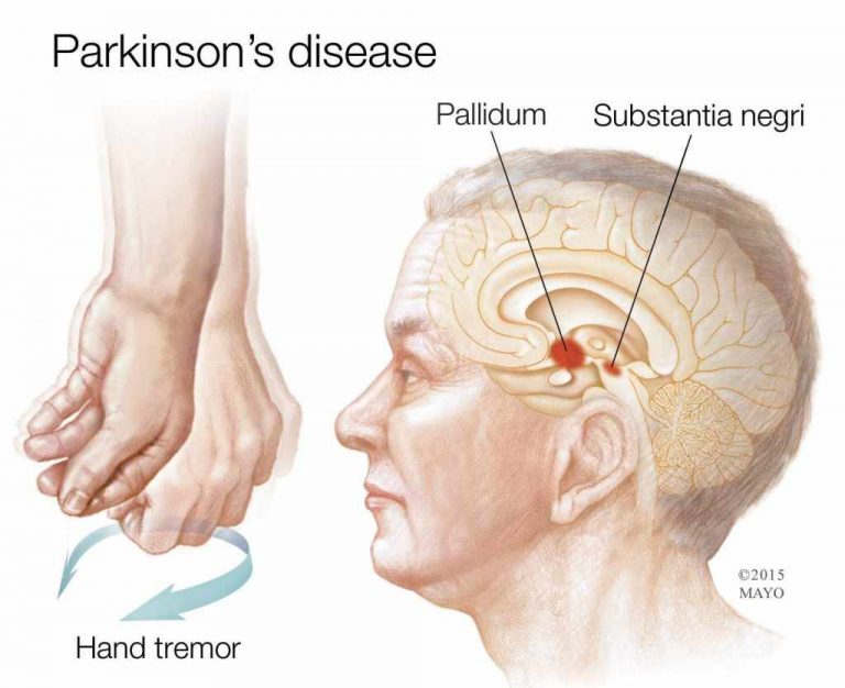 What do you know about Parkinson's disease? - Mayo Clinic News Network