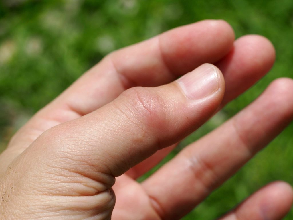 Home Remedies: Just jammed your finger? - Mayo Clinic News Network