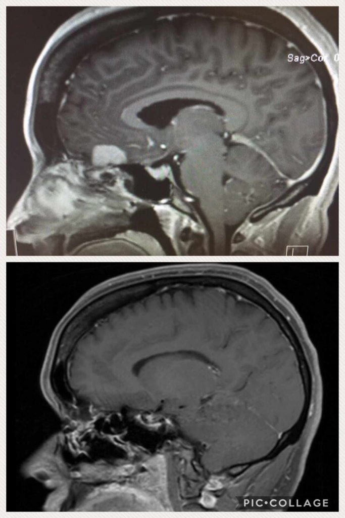 Innovative brain tumor surgery leaves patients with no visible scarring ...