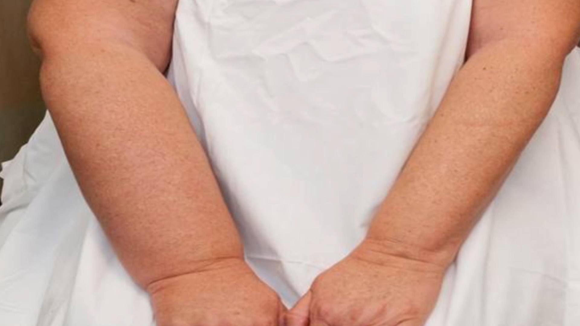 Mayo Clinic Minute: Lymphedema risk is not just about surgery - Mayo ...