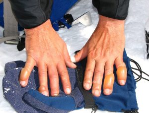 Cold weather medical emergencies to know about: frostbite and ...