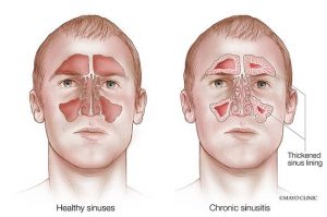 Home Remedies: Steps to help relieve sinusitis - Mayo Clinic News Network