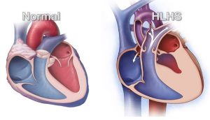 Research collaboration gives hope for future of babies with rare heart ...