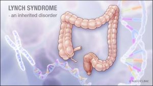 Mayo Clinic Q and A: Lynch syndrome and genetic testing - Mayo Clinic ...