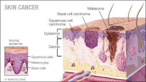 Living With Cancer: Understanding squamous cell carcinoma - Mayo Clinic ...