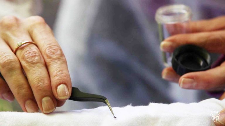 Mayo Clinic Q and A: How to remove a tick quickly and correctly - Mayo ...