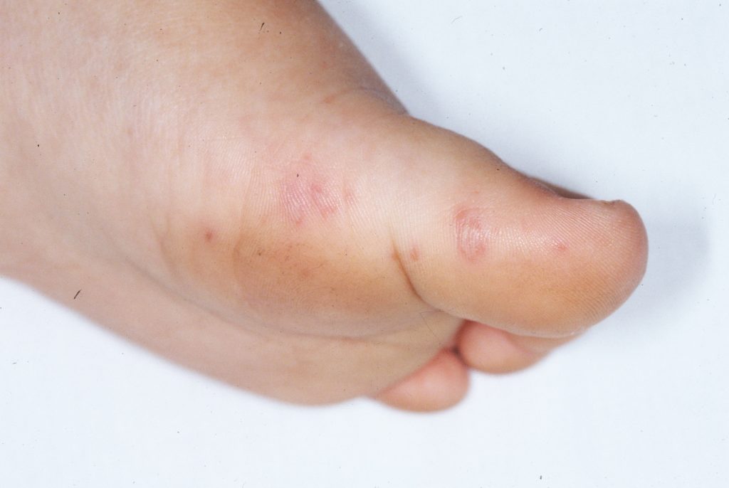 Infectious Diseases A-Z: What is hand, foot and mouth disease? - Mayo ...