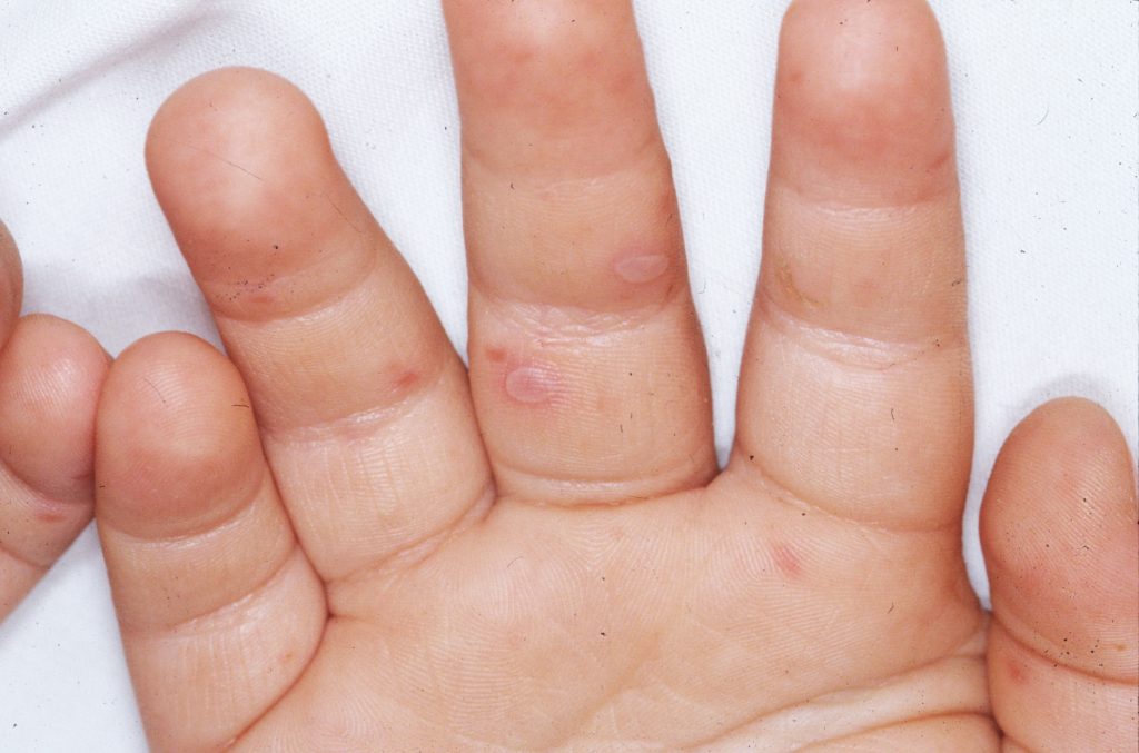 Infectious Diseases A-Z: What is hand, foot and mouth disease? - Mayo ...