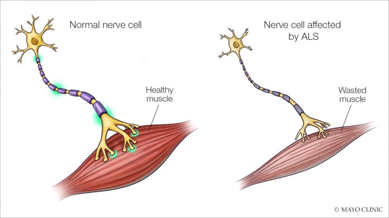 Mayo Clinic Radio: ALS - Mayo Clinic News Network