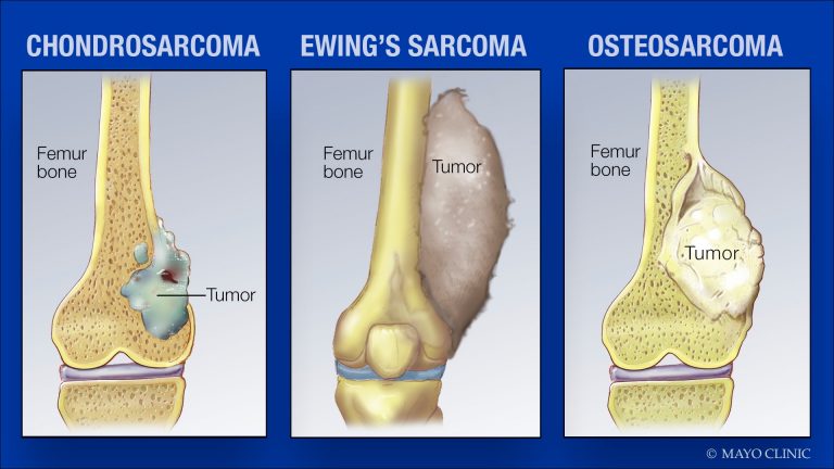 Mayo Clinic Q&A podcast: Be aware of the rare cancer called sarcoma ...