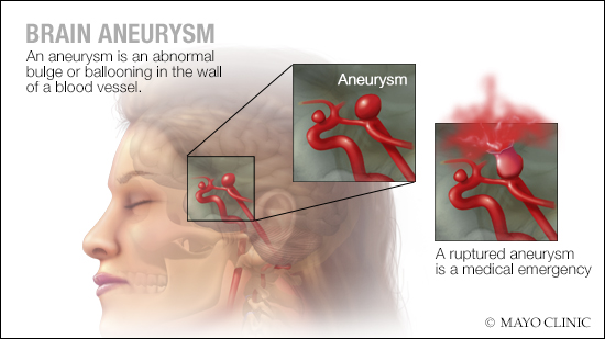 Mayo Clinic Minute: What's an aneurysm? - Mayo Clinic News Network