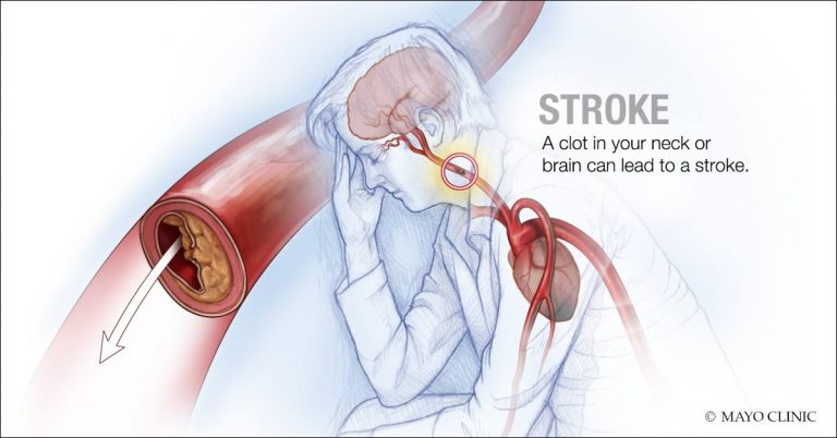 Expert Alert: FAST response essential for stroke - Mayo Clinic News Network