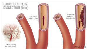 Mayo Clinic Q and A: Treating a carotid artery tear - Mayo Clinic News ...