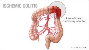 Mayo Clinic Q and A: Understanding ischemic colitis - Mayo Clinic News Network
