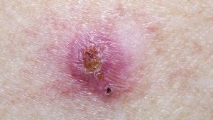 Common Types & Symptoms of Skin Cancer - Baton Rouge Clinic