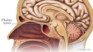 Mayo Clinic Q&A podcast: Understanding pituitary tumors - Mayo Clinic ...