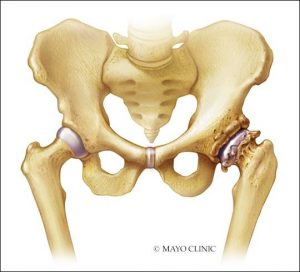 What are bone spurs? - Mayo Clinic News Network