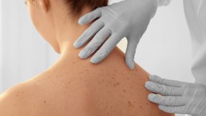 When might a mole mean cancer? - Mayo Clinic News Network
