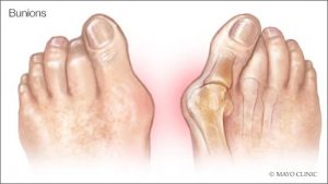 Mayo Clinic Q and A: Bunion treatment and surgery - Mayo Clinic News ...