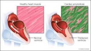 Cardiac amyloidosis 101: Why early diagnosis and targeted treatment ...