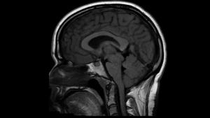 Cerebrospinal fluid leaks are commonly misdiagnosed - Mayo Clinic News ...