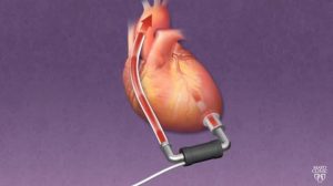 Mayo Clinic Q&A podcast: Ventricular assist devices aid heart failure ...