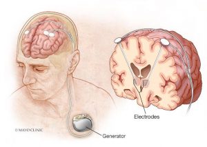 Mayo Clinic Q&A podcast: Using AI to improve brain stimulation devices ...