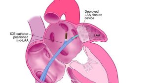 Heart procedure to reduce stroke risk should manage small leaks - Mayo ...