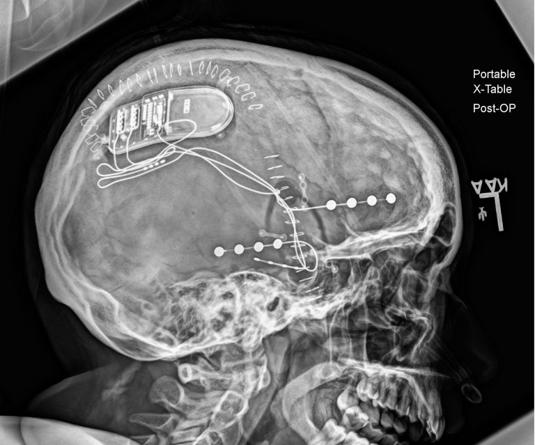 Responsive neurostimulation helps Carlos Martinez help others with ...