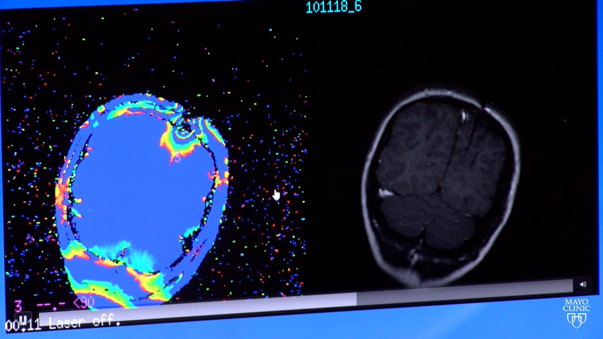 Expert Alert: Laser therapy brings the heat to minimally invasive ...