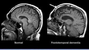 What is frontotemporal dementia? - Mayo Clinic News Network