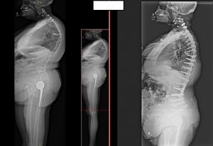 Mayo Clinic Minute: Improving bone health before spinal surgery - Mayo ...