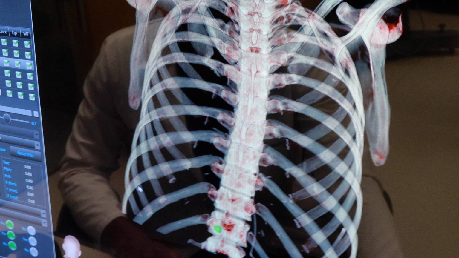 Mayo Clinic Minute: What is augmented reality spine surgery? - Mayo ...