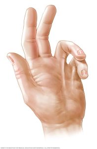 Mayo Clinic Minute Treating Dupuytren Contracture Without Surgery