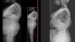 Why improving bone health before complex spine surgery is important ...