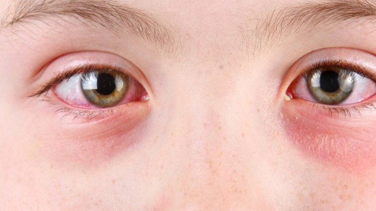 Mayo Clinic Minute: What is pink eye? - Mayo Clinic News Network