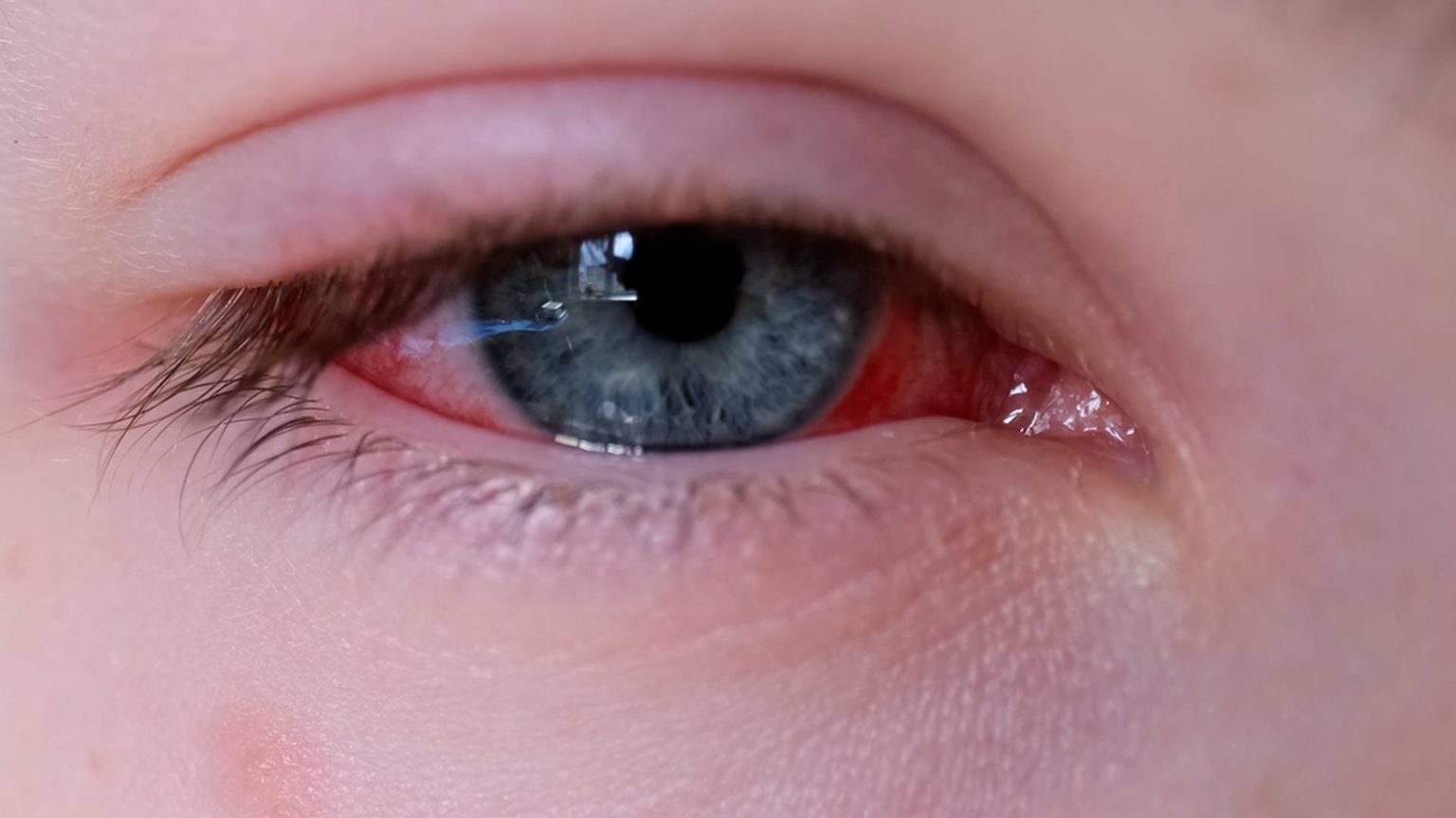 Mayo Clinic Q & A: Seeing clearly: Understanding pink eye - Mayo Clinic ...