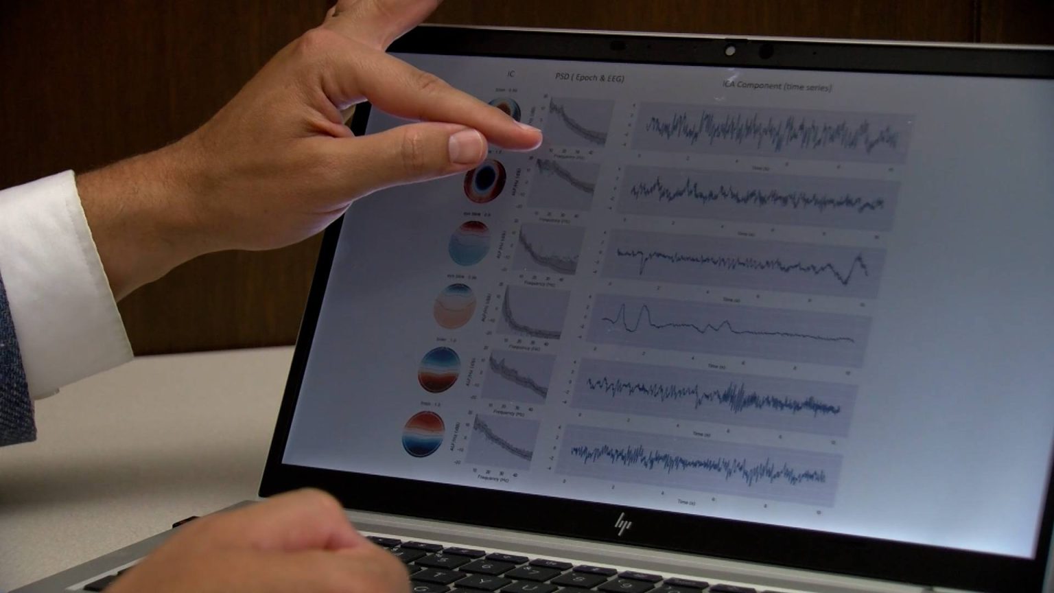 AI boosts the power of EEGs, enabling neurologists to quickly, precisely pinpoint signs of ...