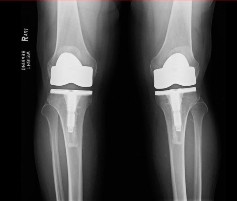 Smart knee technology allows care team to remotely monitor patients ...