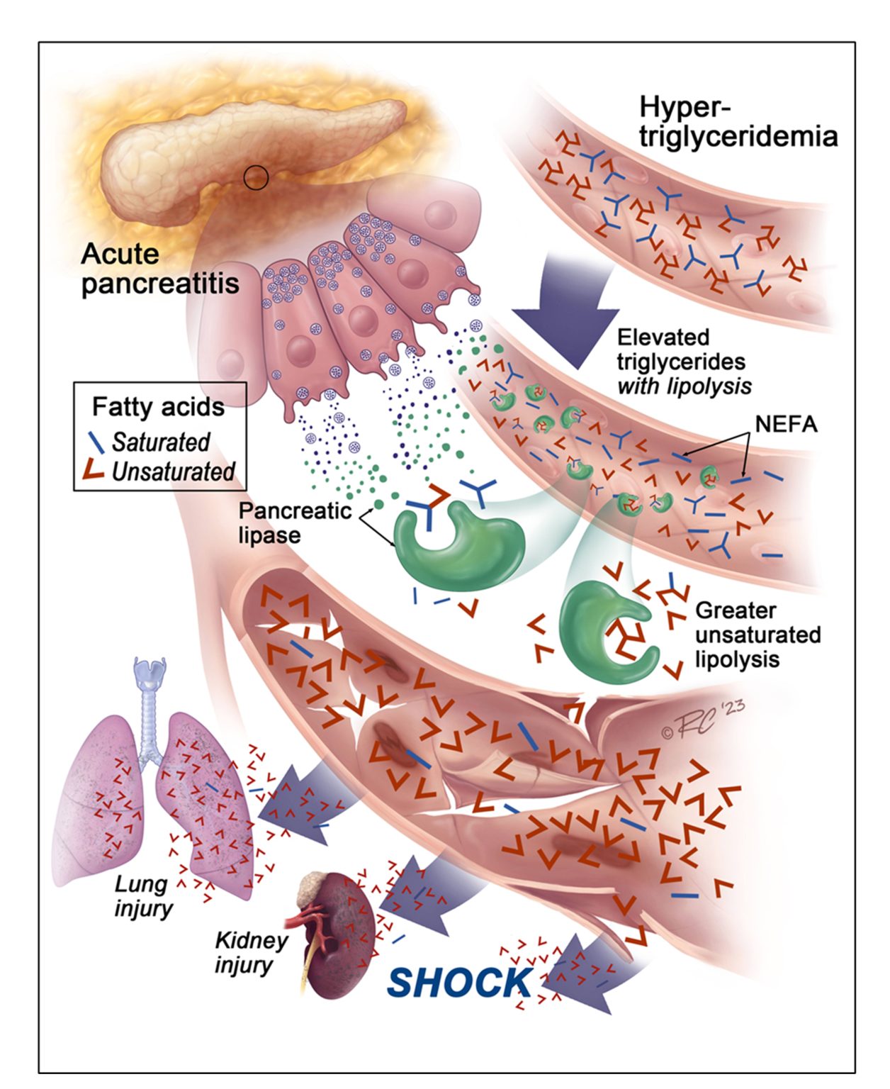 Discovery reveals how to prevent organ damage in pancreatitis - Mayo ...