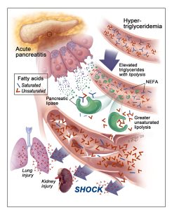 Discovery reveals how to prevent organ damage in pancreatitis - Mayo ...