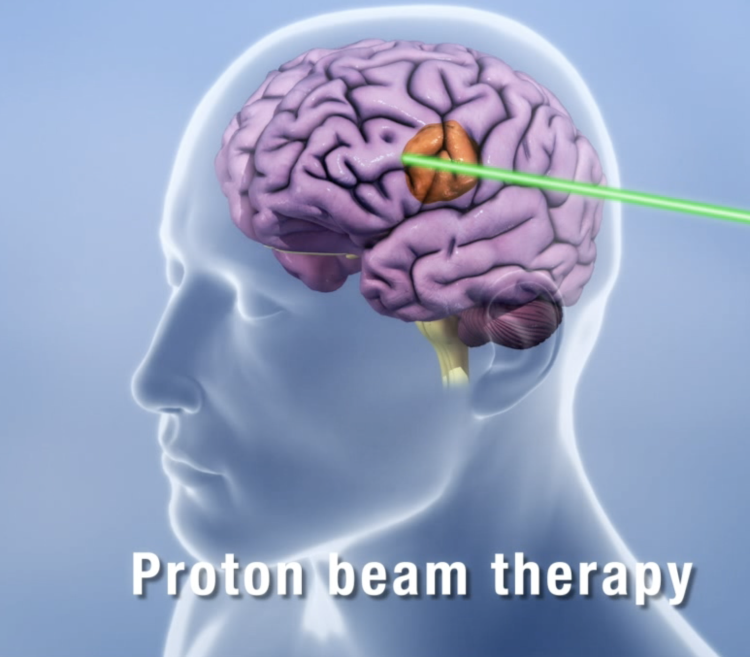 (VIDEO) Breakthrough in the fight against glioblastoma - Mayo Clinic ...